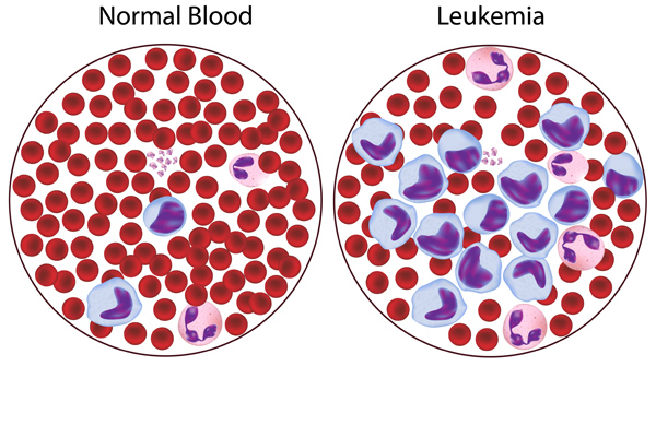 Leukemia